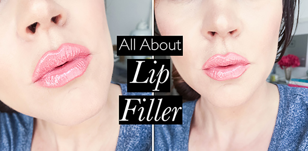 All About Lip Filler - Glam Latte